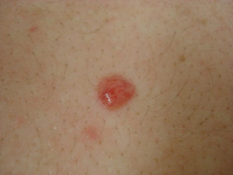 Basal Cell Carcinoma | MoleSafe